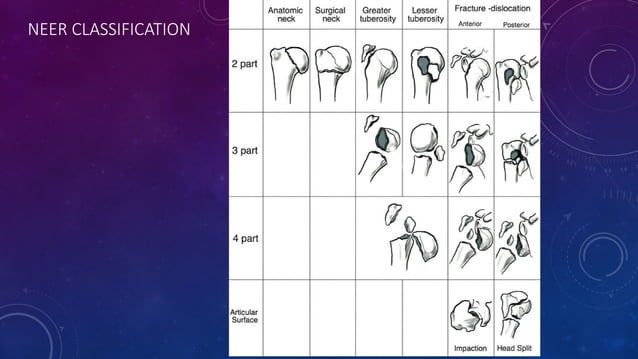 FRACTURE OF PROXIMAL HUMERUS- Etiopathogenesis , clinical features and ...