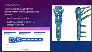 FRACTURE OF PROXIMAL HUMERUS- Etiopathogenesis , clinical features and ...