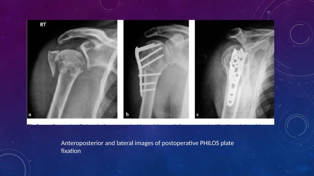FRACTURE OF PROXIMAL HUMERUS- Etiopathogenesis , clinical features and ...