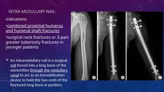 FRACTURE OF PROXIMAL HUMERUS- Etiopathogenesis , clinical features and ...