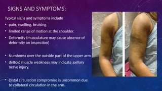 FRACTURE OF PROXIMAL HUMERUS- Etiopathogenesis , clinical features and ...
