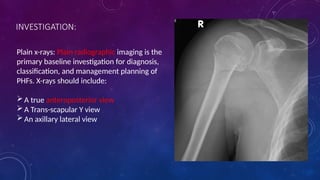 FRACTURE OF PROXIMAL HUMERUS- Etiopathogenesis , clinical features and ...