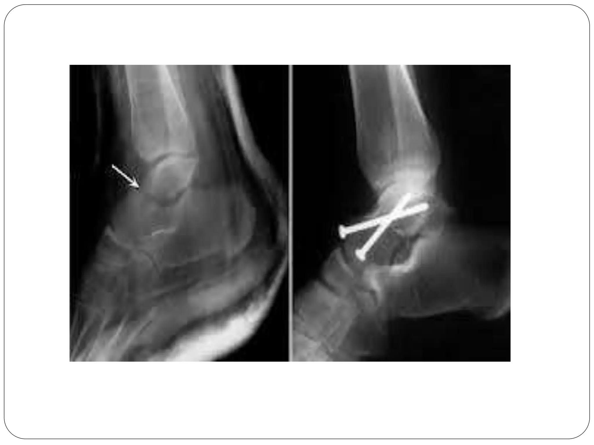 FRACTURE OF TALUS.pptx. ..... | PPT