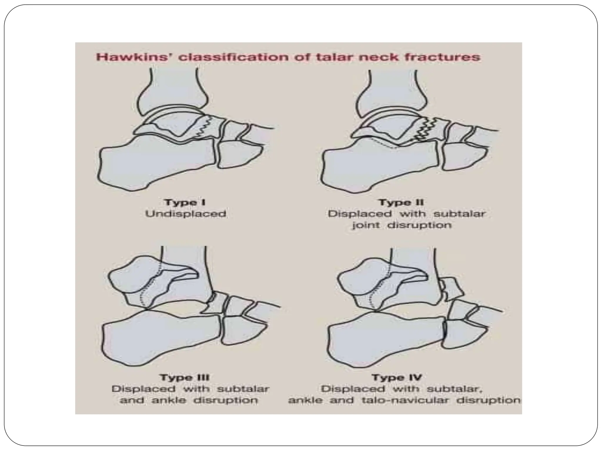 FRACTURE OF TALUS.pptx. ..... | PPT