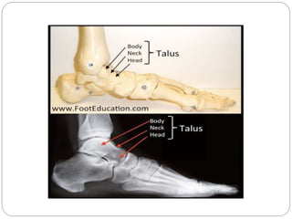 FRACTURE OF TALUS.pptx. ..... | PPT