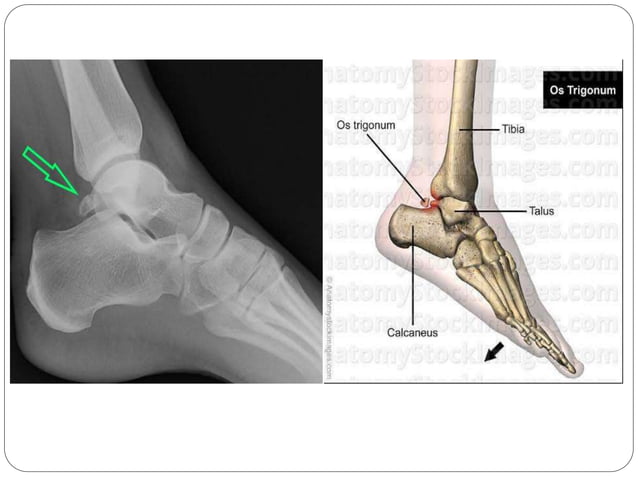 FRACTURE OF TALUS.pptx. ..... | PPT