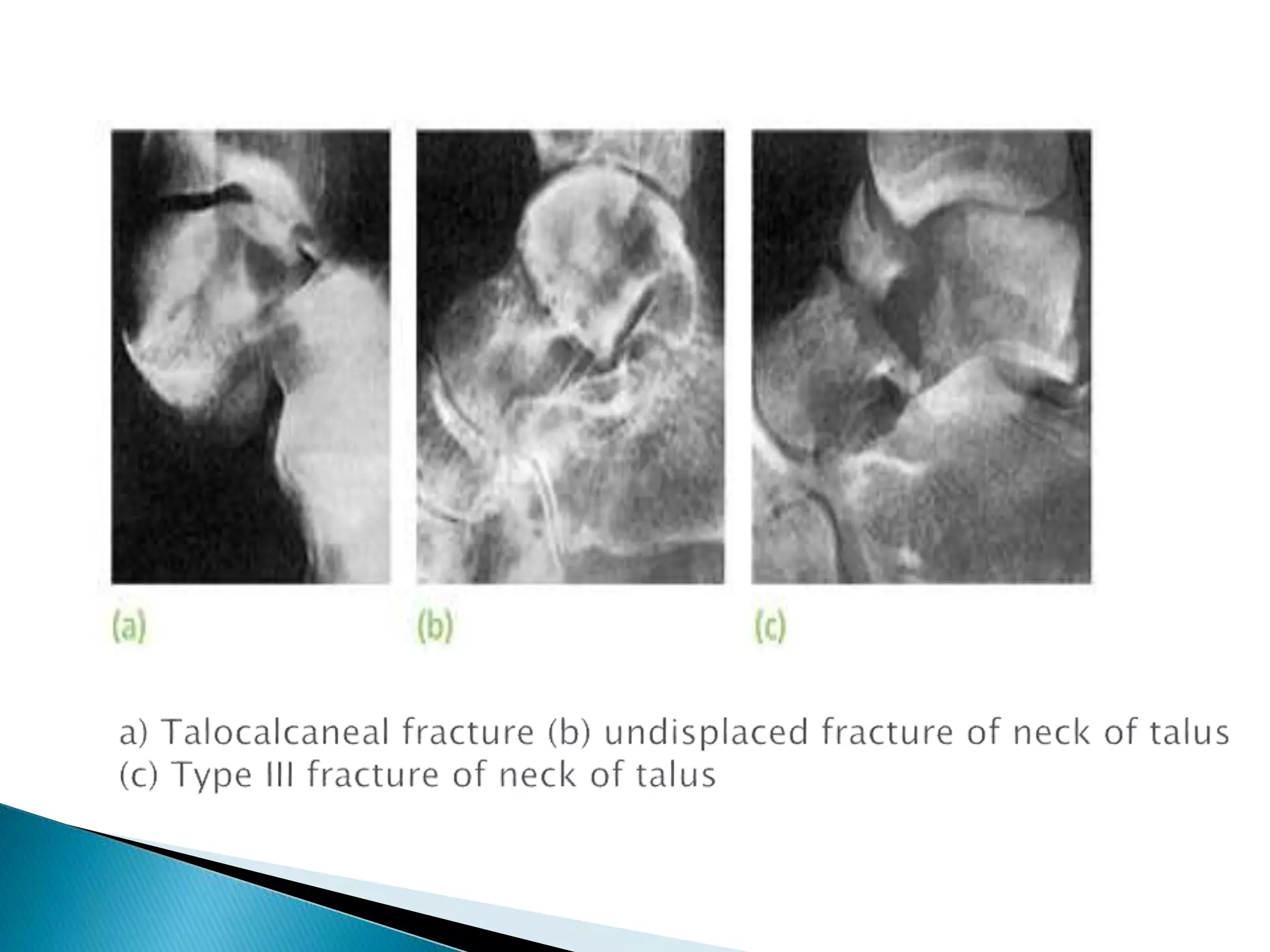 Fracture of talus ppt | PPTX