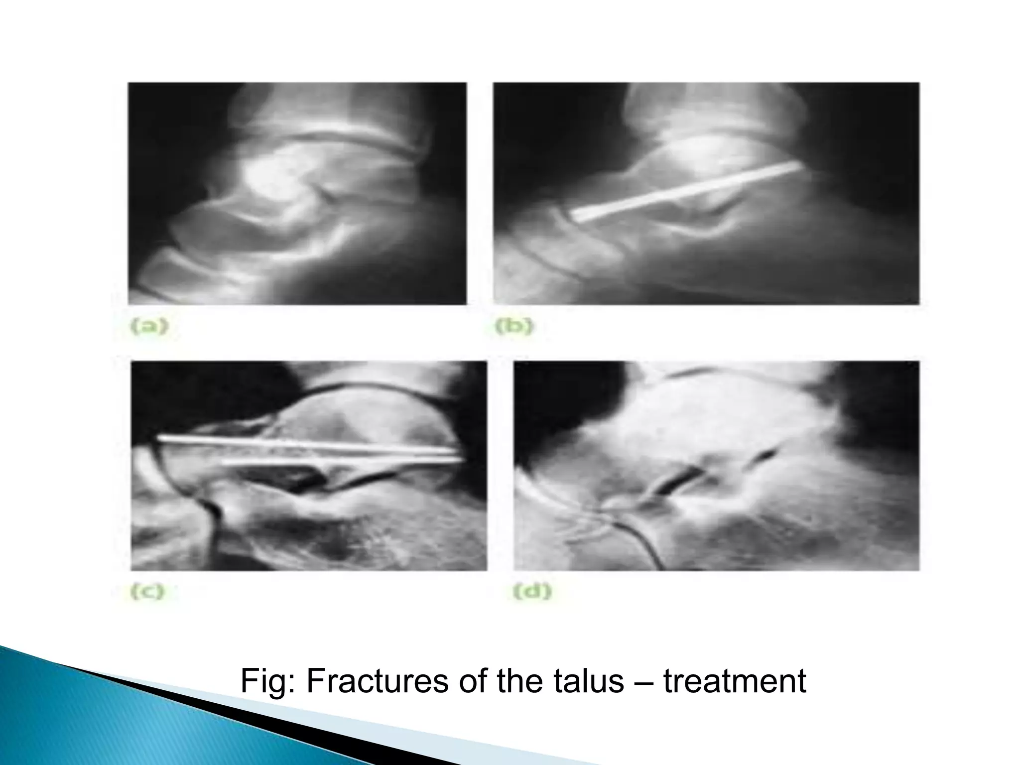 Fracture of talus ppt | PPTX