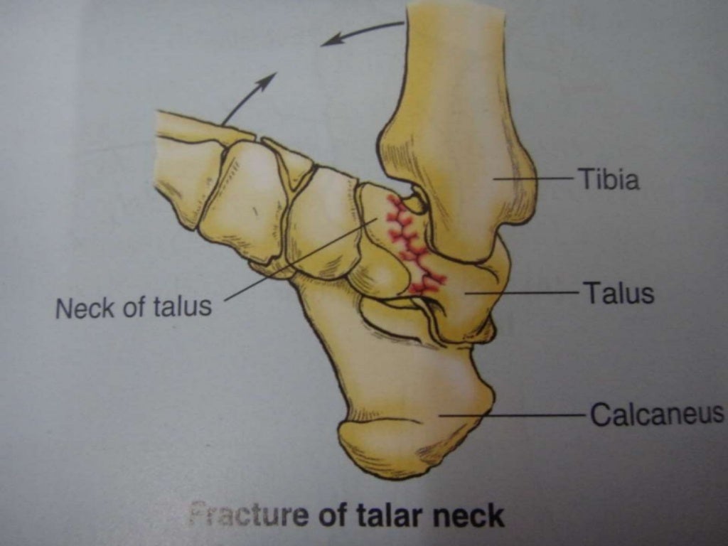 Fracture of talus ppt