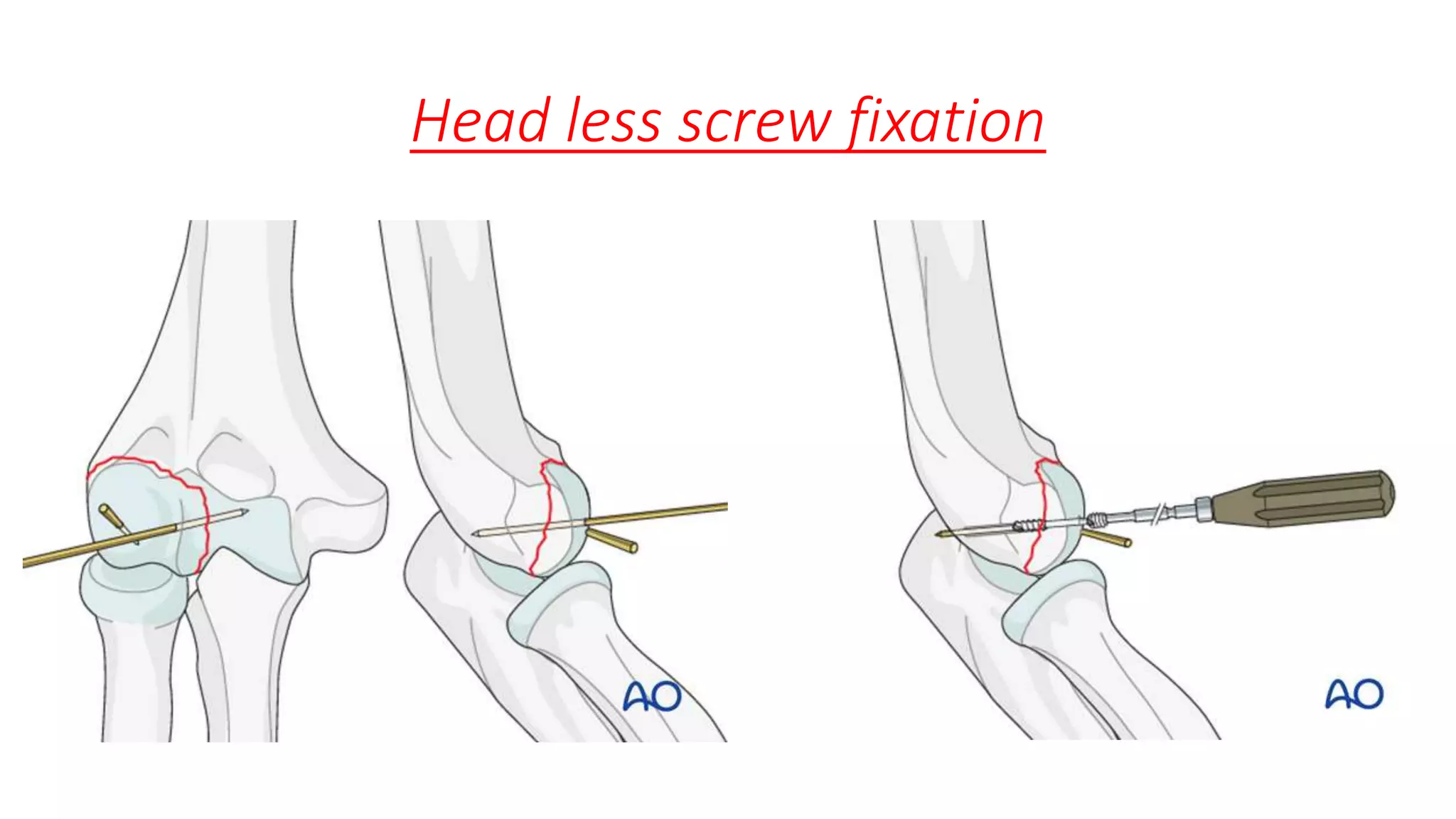 Fracture of the capitellum | PPTX