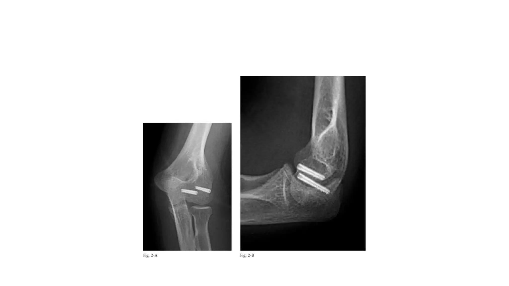 Fracture of the capitellum | PPTX