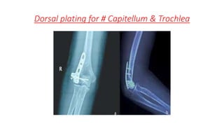 Fracture of the capitellum | PPTX