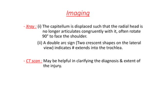 Fracture of the capitellum | PPTX