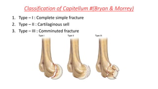Fracture of the capitellum | PPT