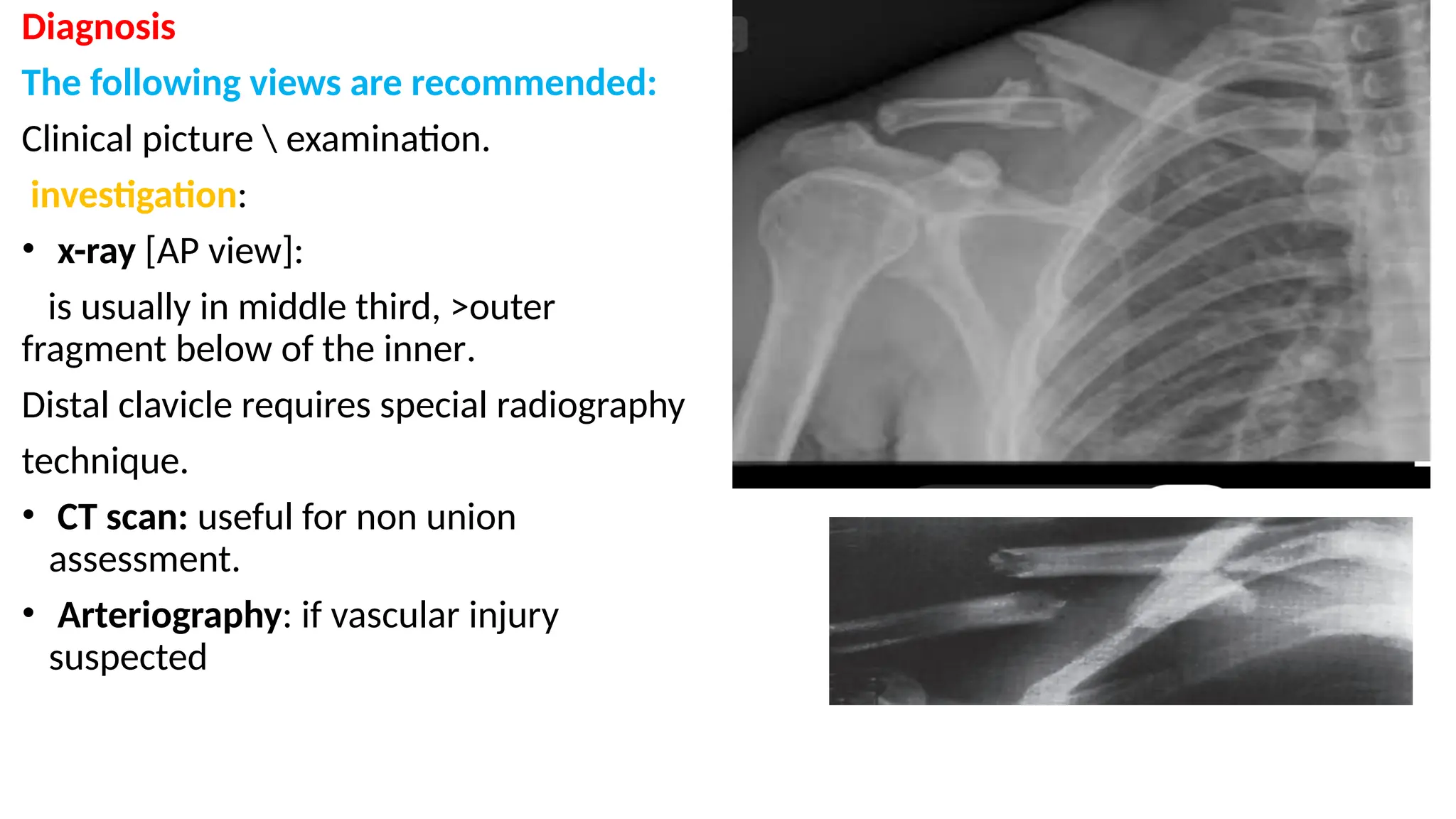 Fracture of the clavical clinical 2.pptx