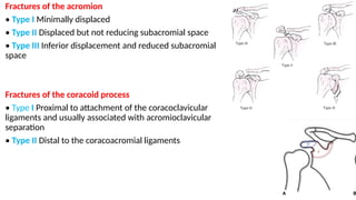 Fracture of the clavical clinical 2.pptx