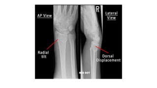 Fracture of the distal radius | PPTX