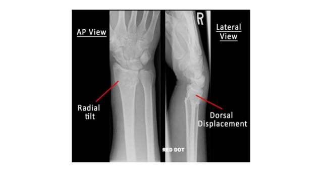 Fracture of the distal radius | PPTX | First Aid | Injuries
