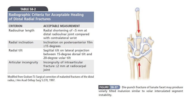 Fracture of the distal radius | PPTX | First Aid | Injuries