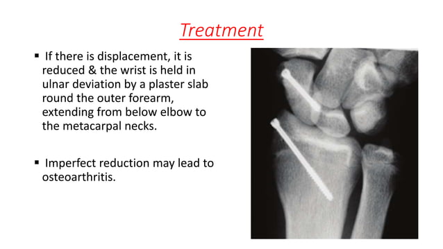 Fracture of the distal radius | PPTX | First Aid | Injuries