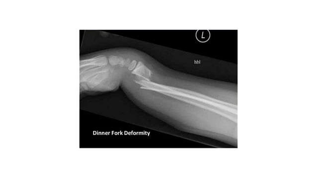Fracture of the distal radius | PPTX | First Aid | Injuries
