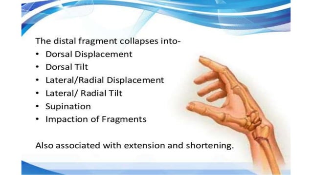 Fracture of the distal radius | PPTX | First Aid | Injuries