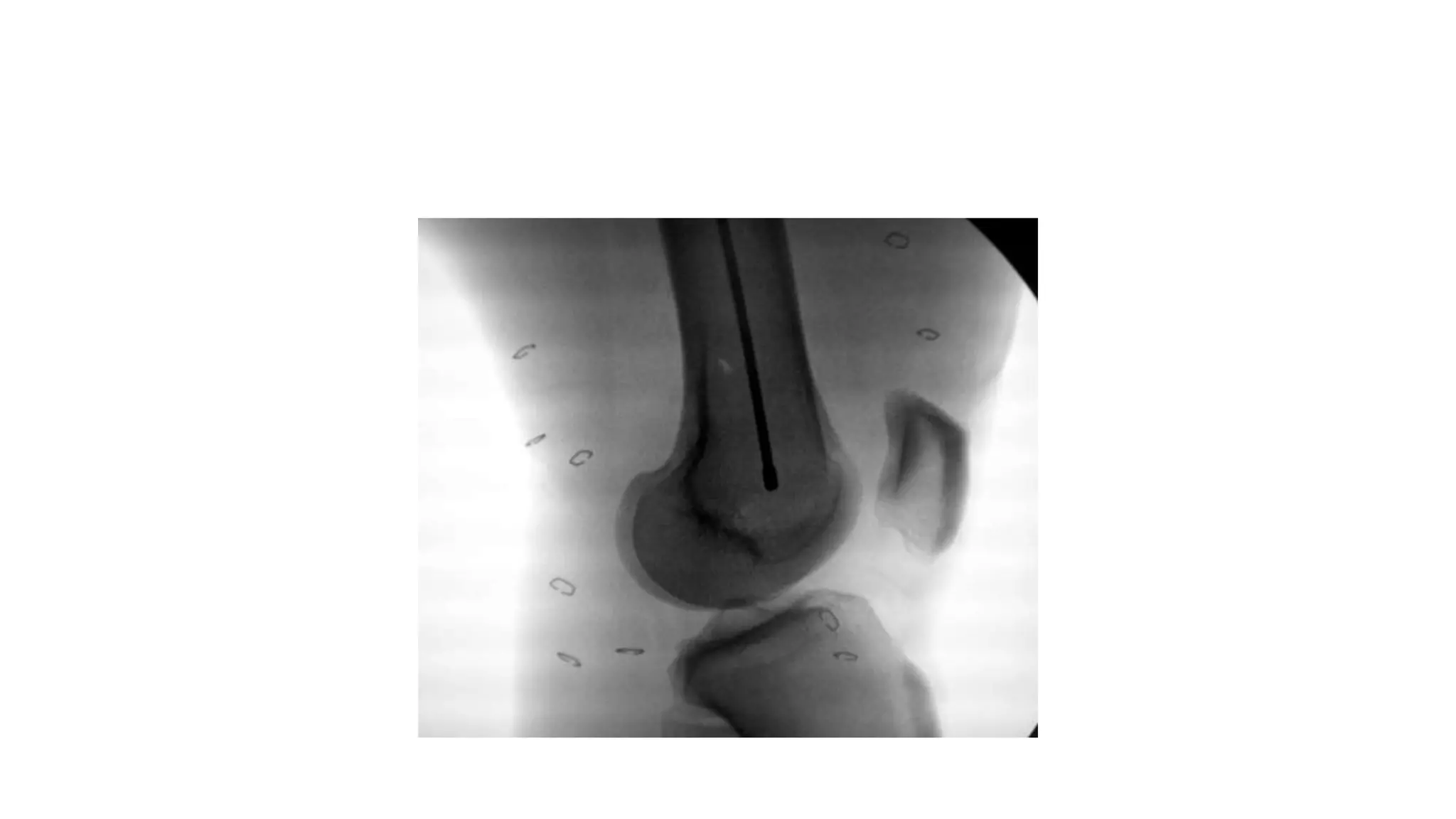 Fracture of the femoral shaft | PPTX