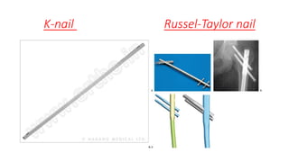 Fracture of the femoral shaft | PPT