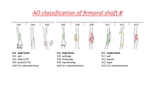 Fracture of the femoral shaft | PPT