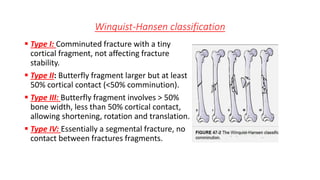 Fracture of the femoral shaft | PPT
