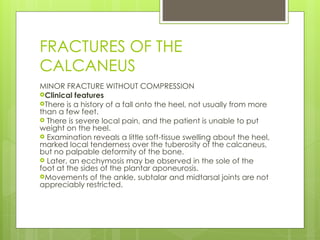 fracture of the foot and parts prone to these fractures | PPT