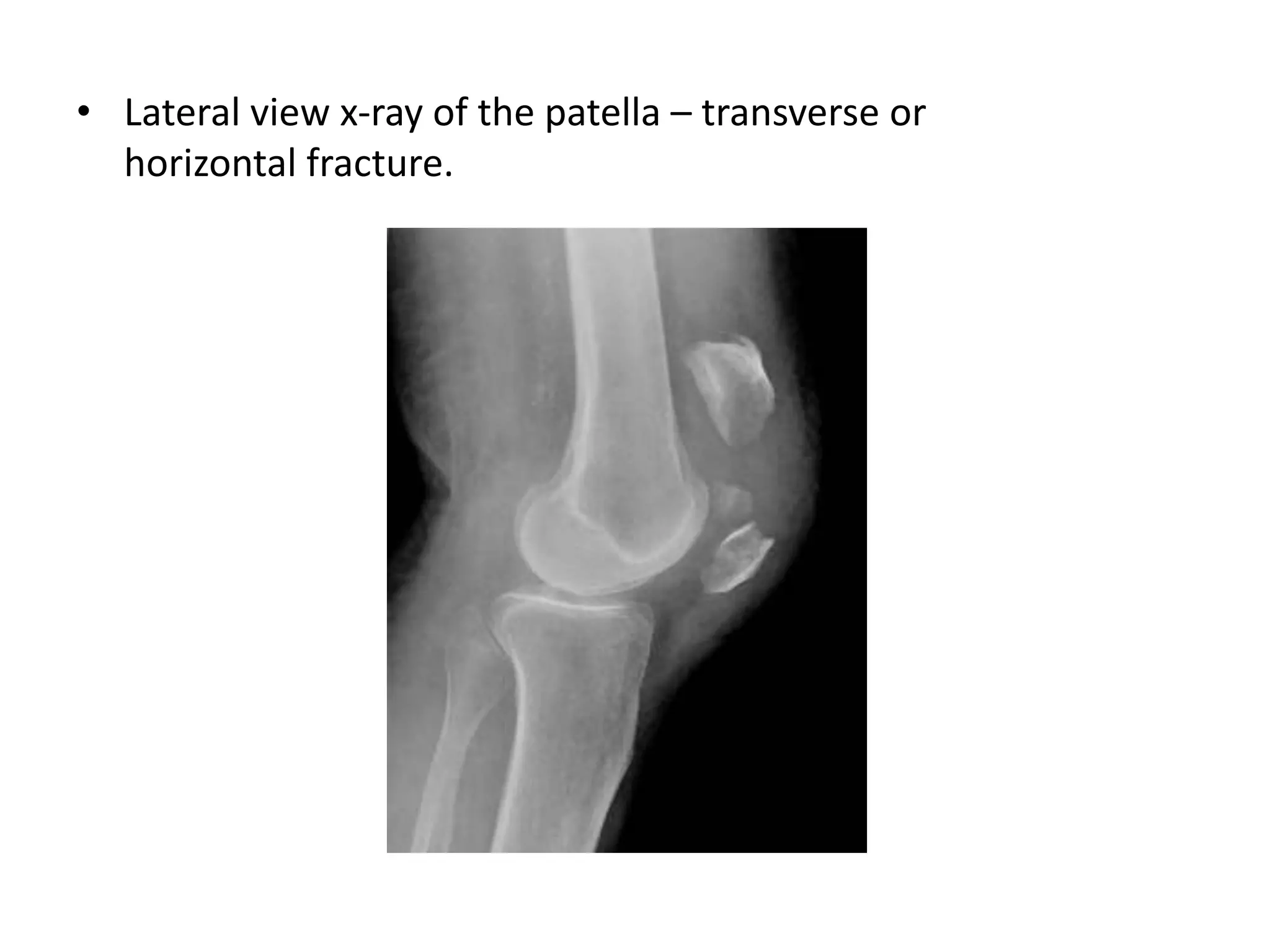 FRACTURE OF THE PATELLA.pptx