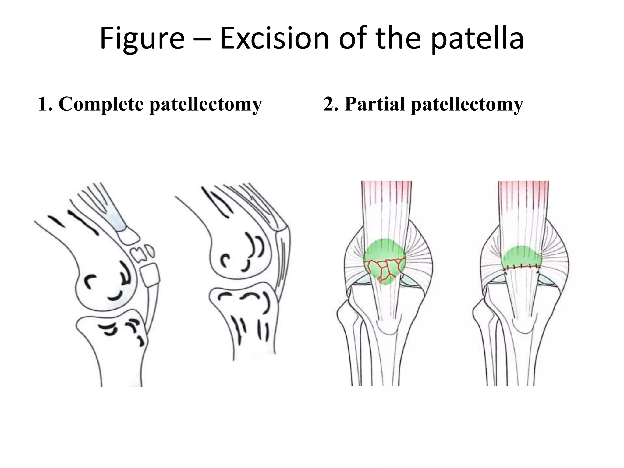 FRACTURE OF THE PATELLA.pptx