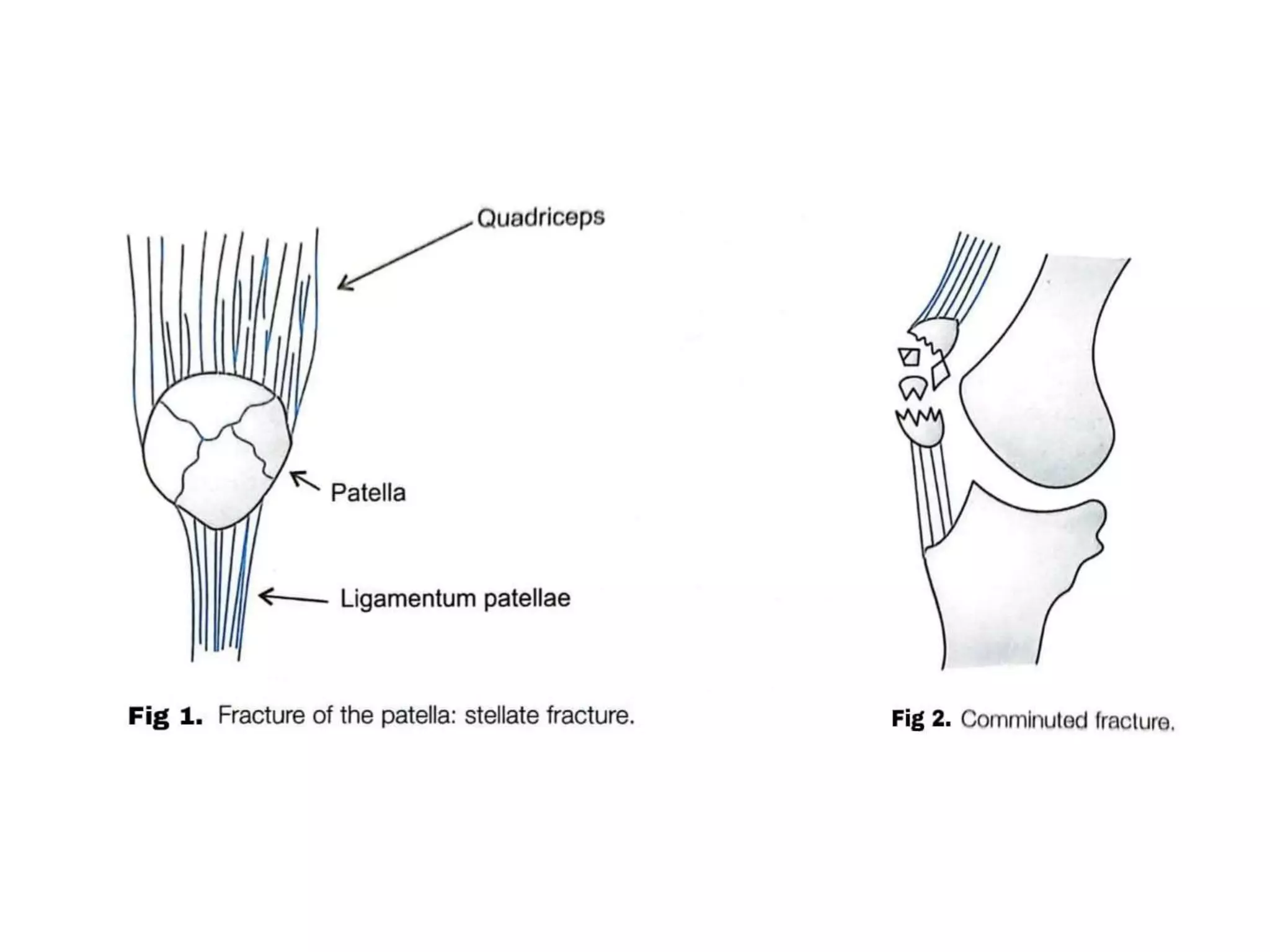 FRACTURE OF THE PATELLA.pptx