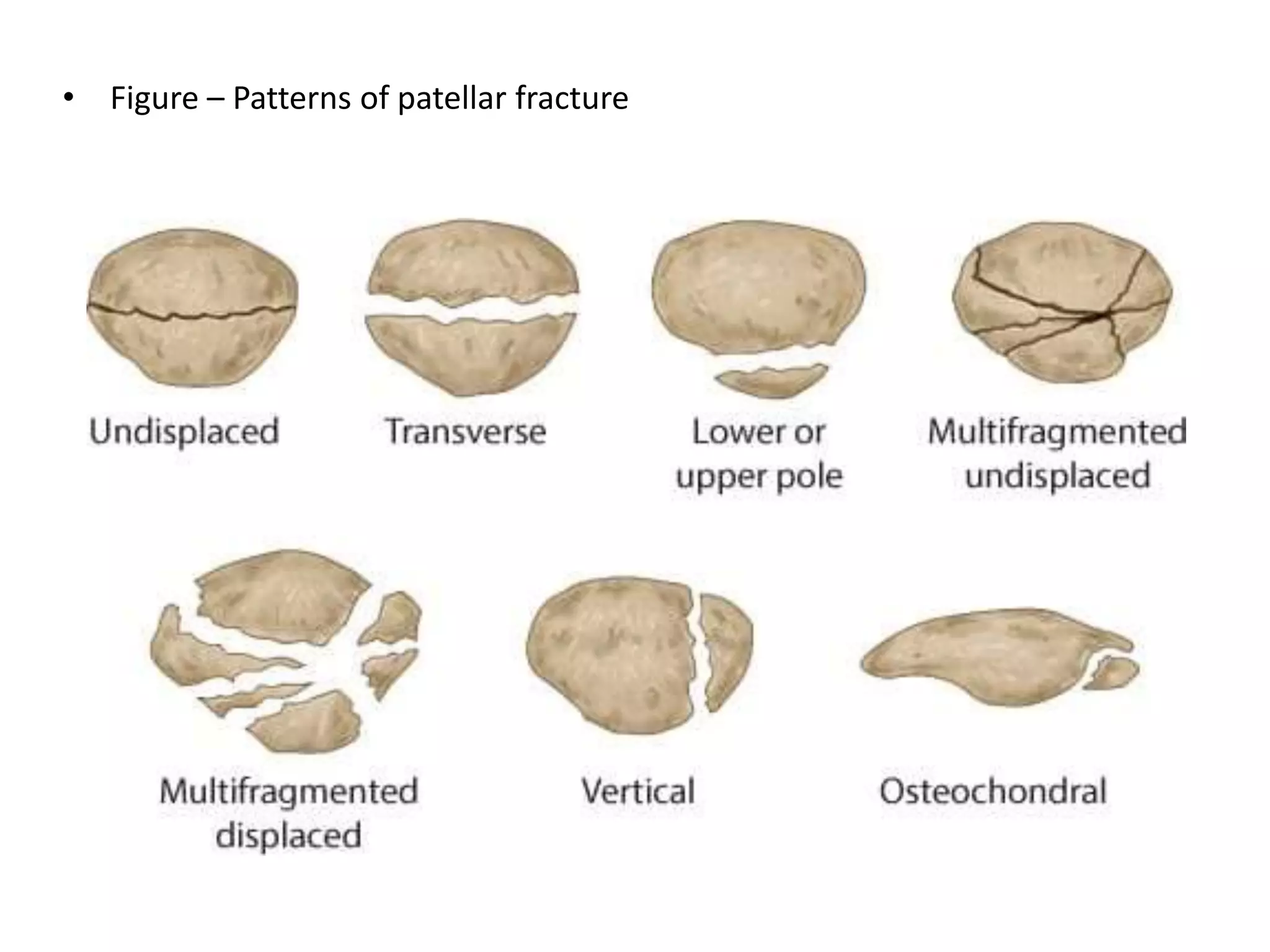 FRACTURE OF THE PATELLA.pptx