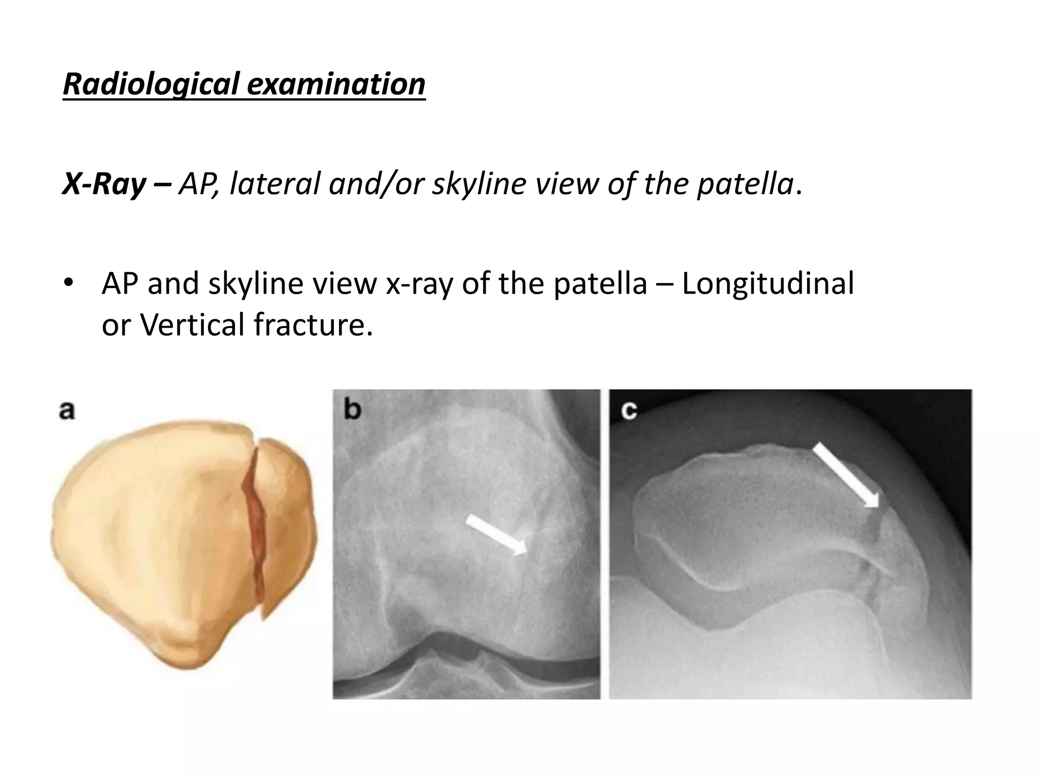 FRACTURE OF THE PATELLA.pptx