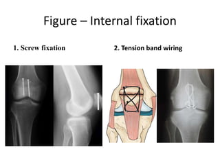 FRACTURE OF THE PATELLA.pptx