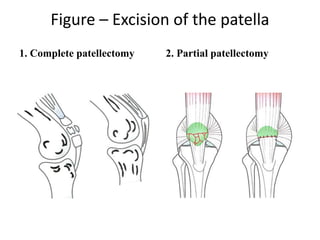FRACTURE OF THE PATELLA.pptx