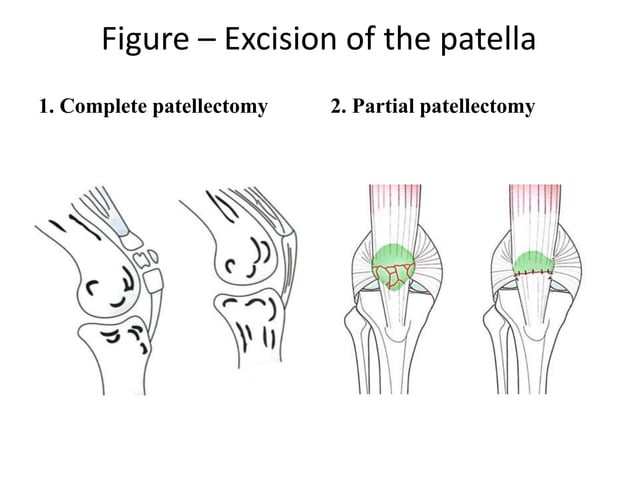 FRACTURE OF THE PATELLA.pptx