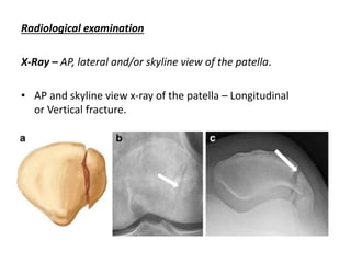 FRACTURE OF THE PATELLA.pptx