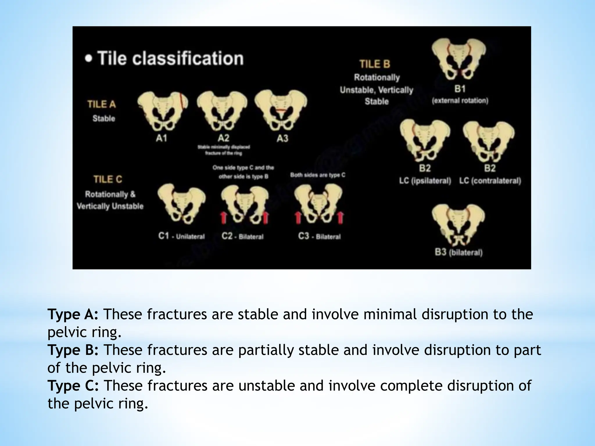 Fractures of the Pelvis bone and its physiotherapy rehabilitation .pptx