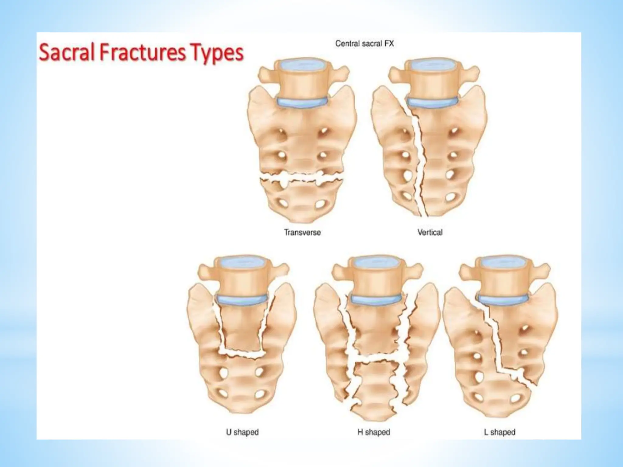 Fractures of the Pelvis bone and its physiotherapy rehabilitation .pptx