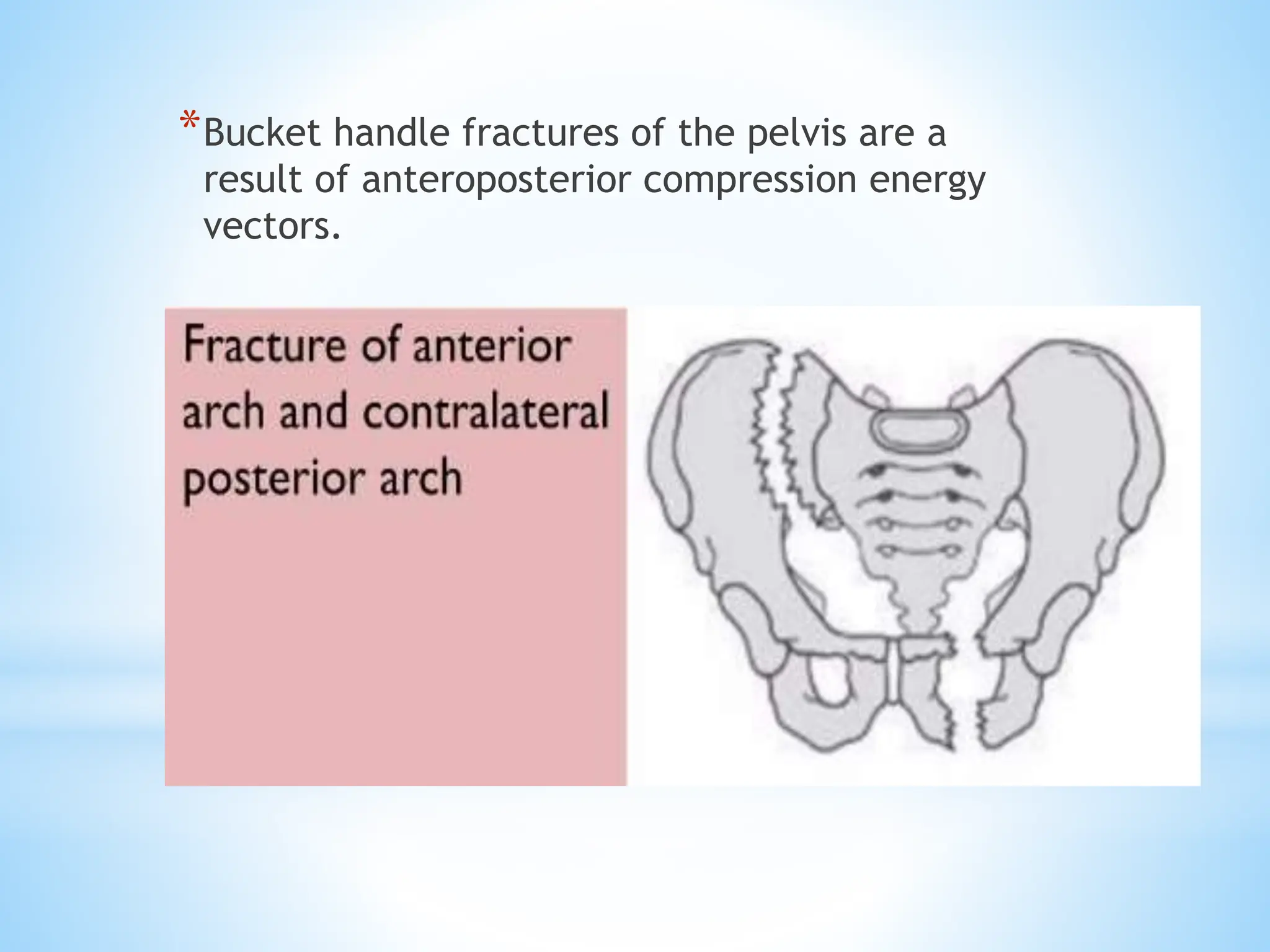 Fractures of the Pelvis bone and its physiotherapy rehabilitation .pptx