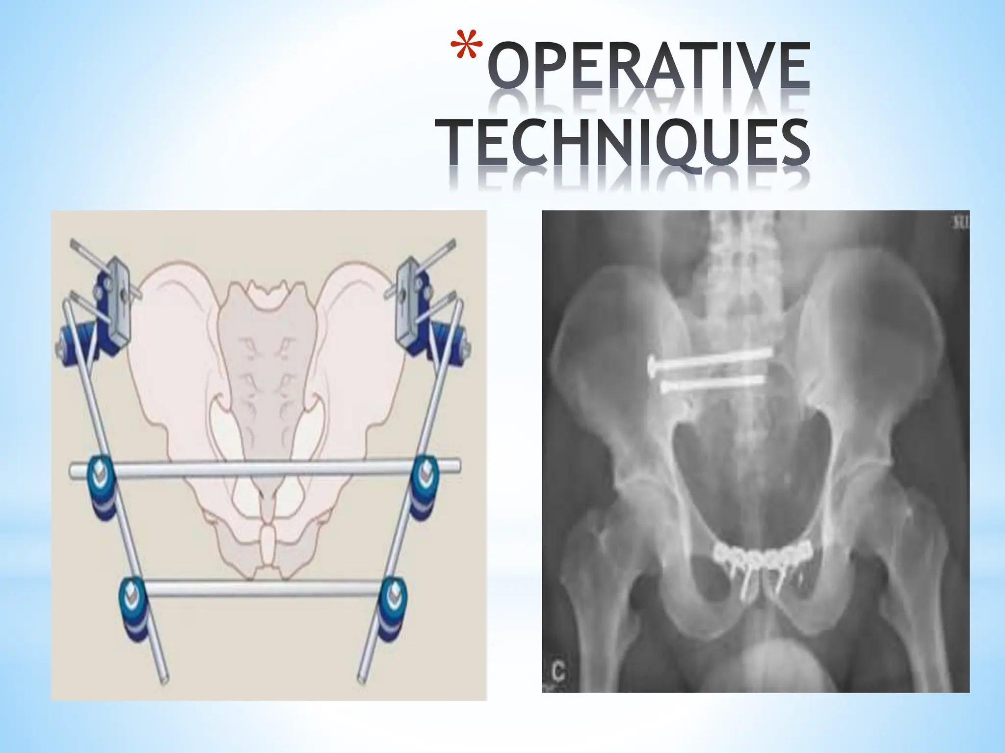 Fractures of the Pelvis bone and its physiotherapy rehabilitation .pptx