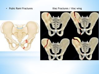 Fractures of the Pelvis bone and its physiotherapy rehabilitation .pptx