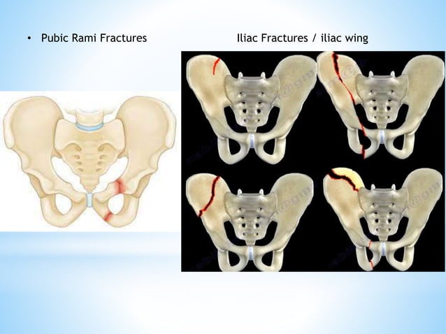 Fractures of the Pelvis bone and its physiotherapy rehabilitation .pptx