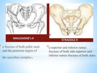 Fractures of the Pelvis bone and its physiotherapy rehabilitation .pptx