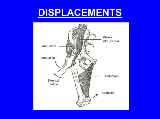 FRACTURE OF THE SHAFT OF THE FEMUR.ppt