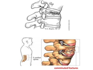Fracture of the Spine as one of the major orthopedic trauma .pdf
