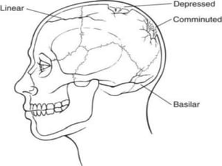 FRACTURE OF THE VAULT OF THE SKULL .ppt